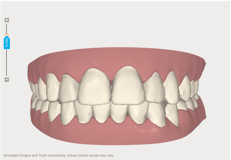 Invisalign Clear Braces | High Oaks Dental Practice